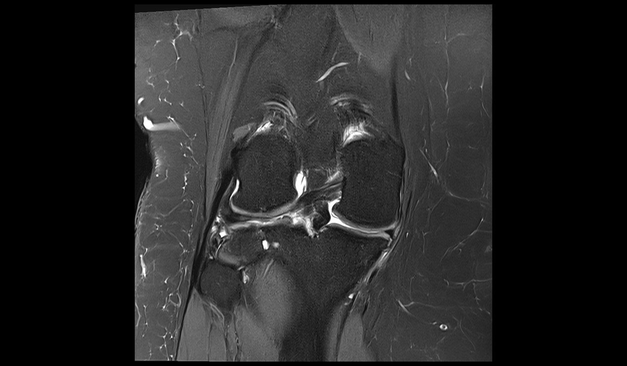 Anterior cruciate ligament tear MRI | Radiology Article on ACL tear