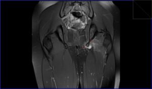 Hamstring Injury MRI | Radiology article on Hamstring Injury