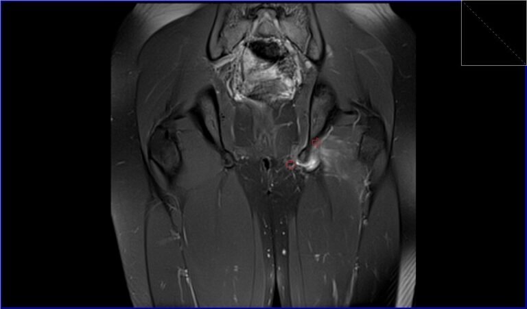 Hamstring Injury MRI | Radiology article on Hamstring Injury