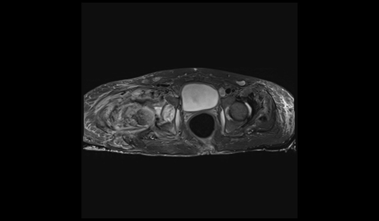 Pelvic ostiomelitis MRI | Radiology article on Pelvic osteomyelitis