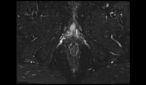 Perianal fistula MRI | Radiology article on Perianal fistula MRI