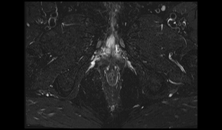 Perianal fistula MRI | Radiology article on Perianal fistula MRI