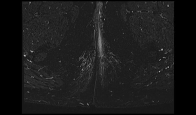 Perianal fistula MRI | Radiology article on Perianal fistula MRI