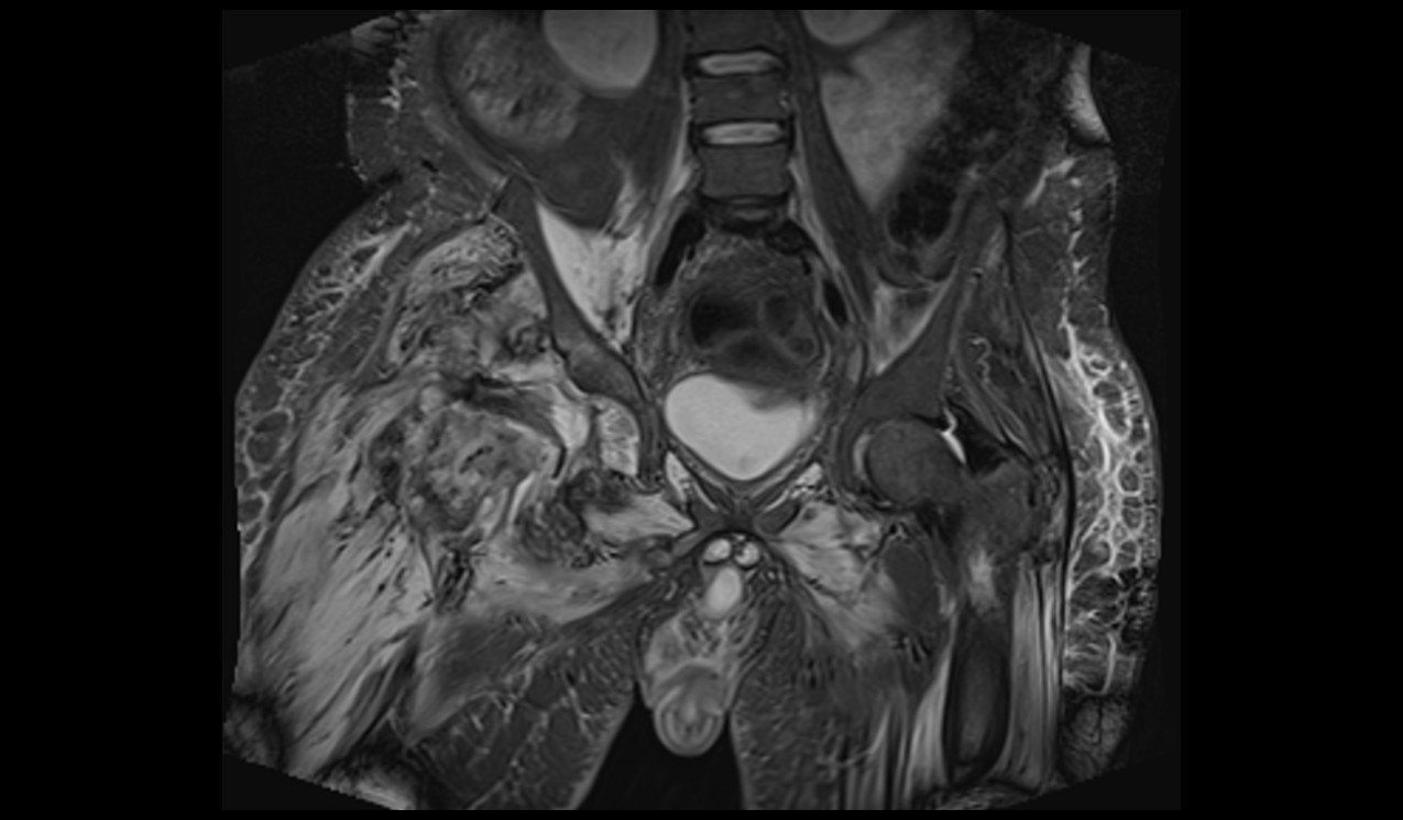 Pelvic ostiomelitis MRI | Radiology article on Pelvic osteomyelitis