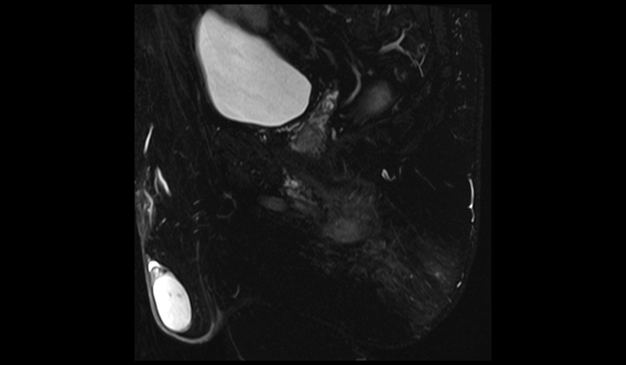Perianal fistula MRI | Radiology article on Perianal fistula MRI