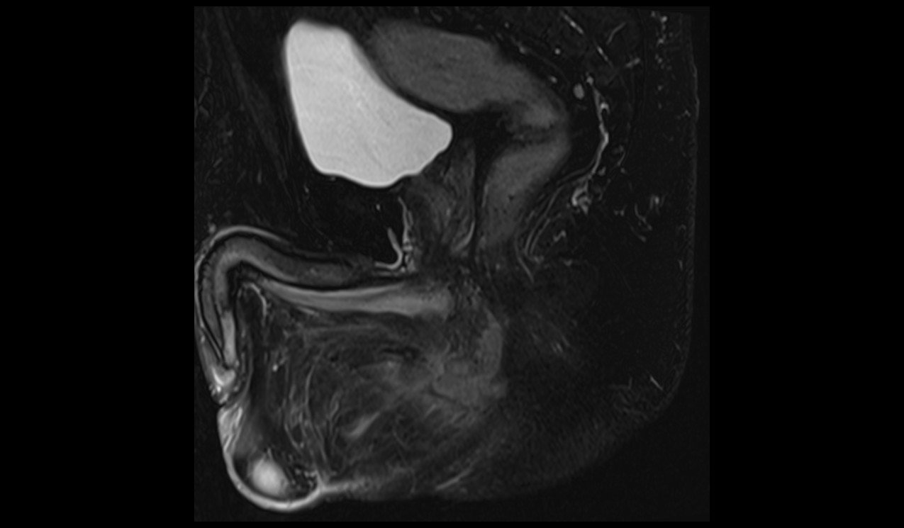 Perianal fistula MRI | Radiology article on Perianal fistula MRI