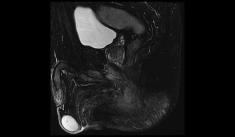 Perianal Fistula Mri Radiology Article On Perianal Fistula Mri