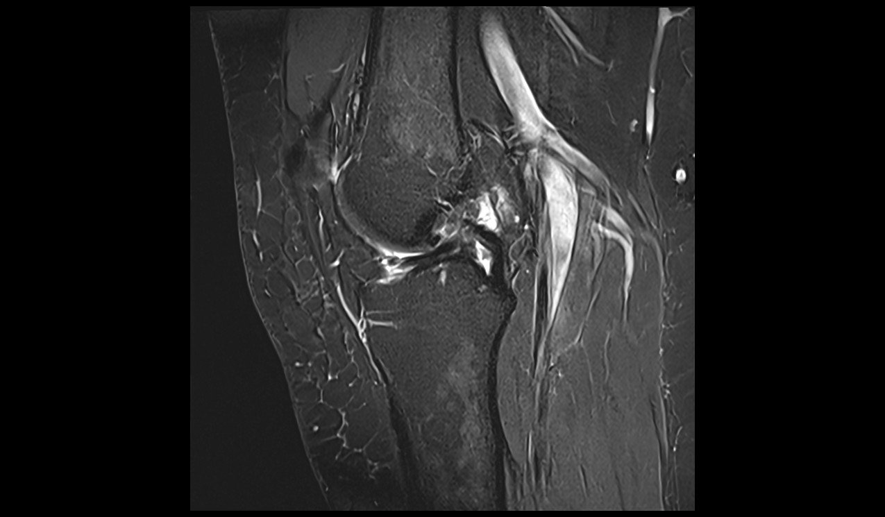 Anterior cruciate ligament tear MRI | Radiology Article on ACL tear