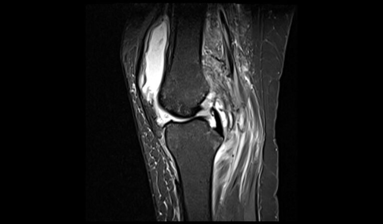 Knee Synovitis MRI| Radiology Article on Knee Synovitis