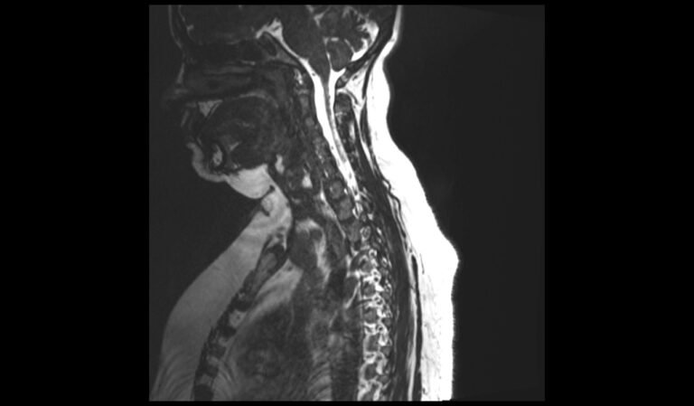 CISS MRI sequence | FIESTA-C MRI | phase balanced sarge | PBSG physics ...