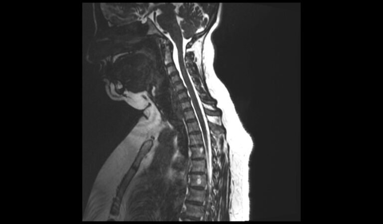 CISS MRI sequence | FIESTA-C MRI | phase balanced sarge | PBSG physics ...