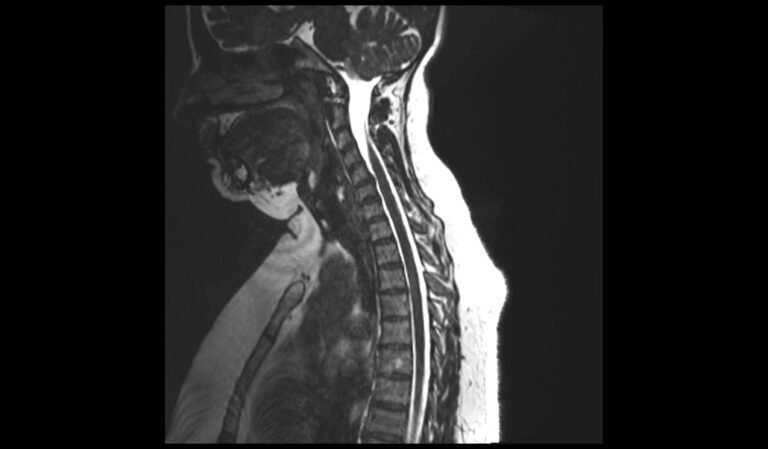 CISS MRI sequence | FIESTA-C MRI | phase balanced sarge | PBSG physics ...