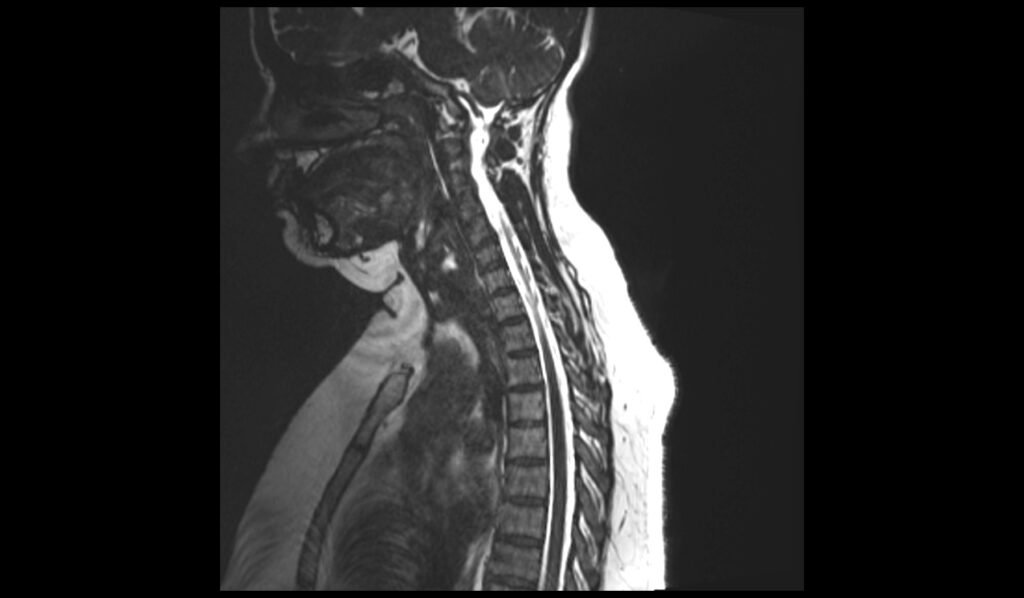 CISS MRI sequence | FIESTA-C MRI | phase balanced sarge | PBSG physics ...