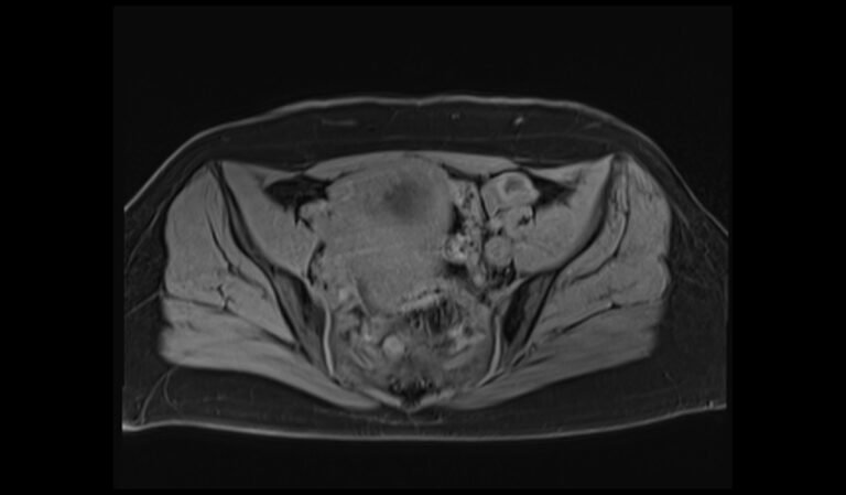 Iliofemoral deep vein thrombosis (DVT) MRI