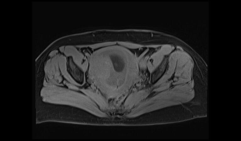 Iliofemoral deep vein thrombosis (DVT) MRI