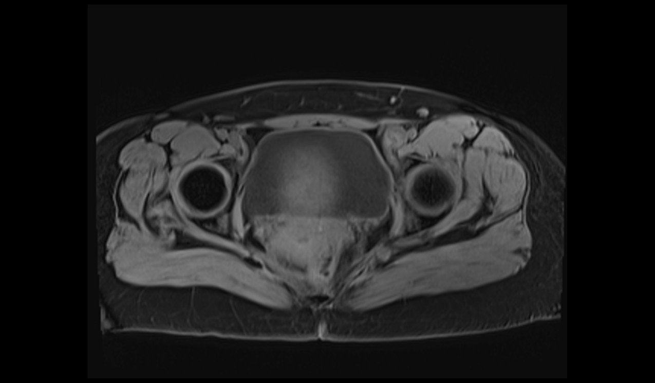 Iliofemoral deep vein thrombosis (DVT) MRI