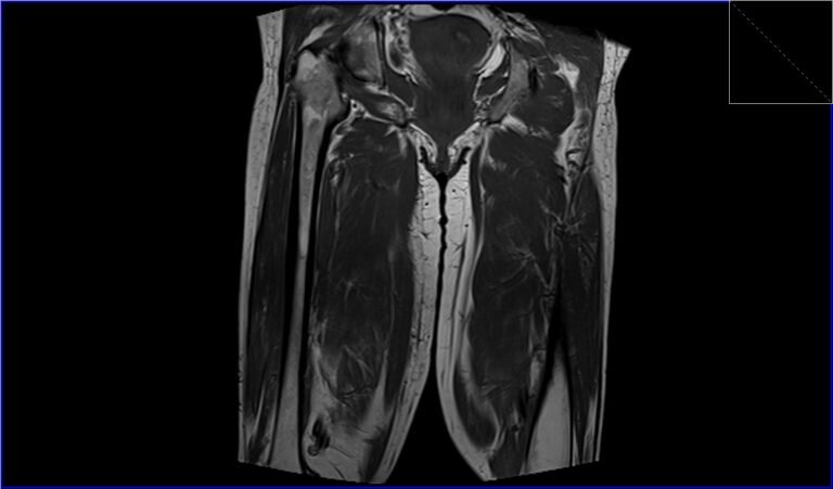 Infectious Myositis MRI | Radiology article on Infectious Myositis