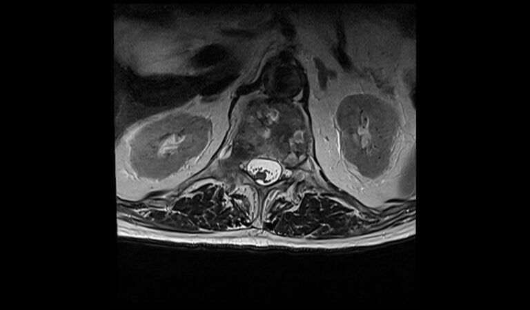 Spinal metastases MRI | Radiology article on spinal metastases