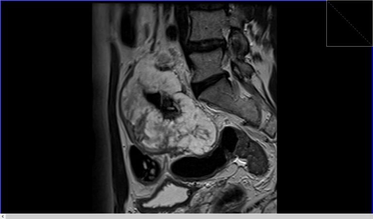 Cecal tumor MRI | Radiology Article on Cecal Carcinoma