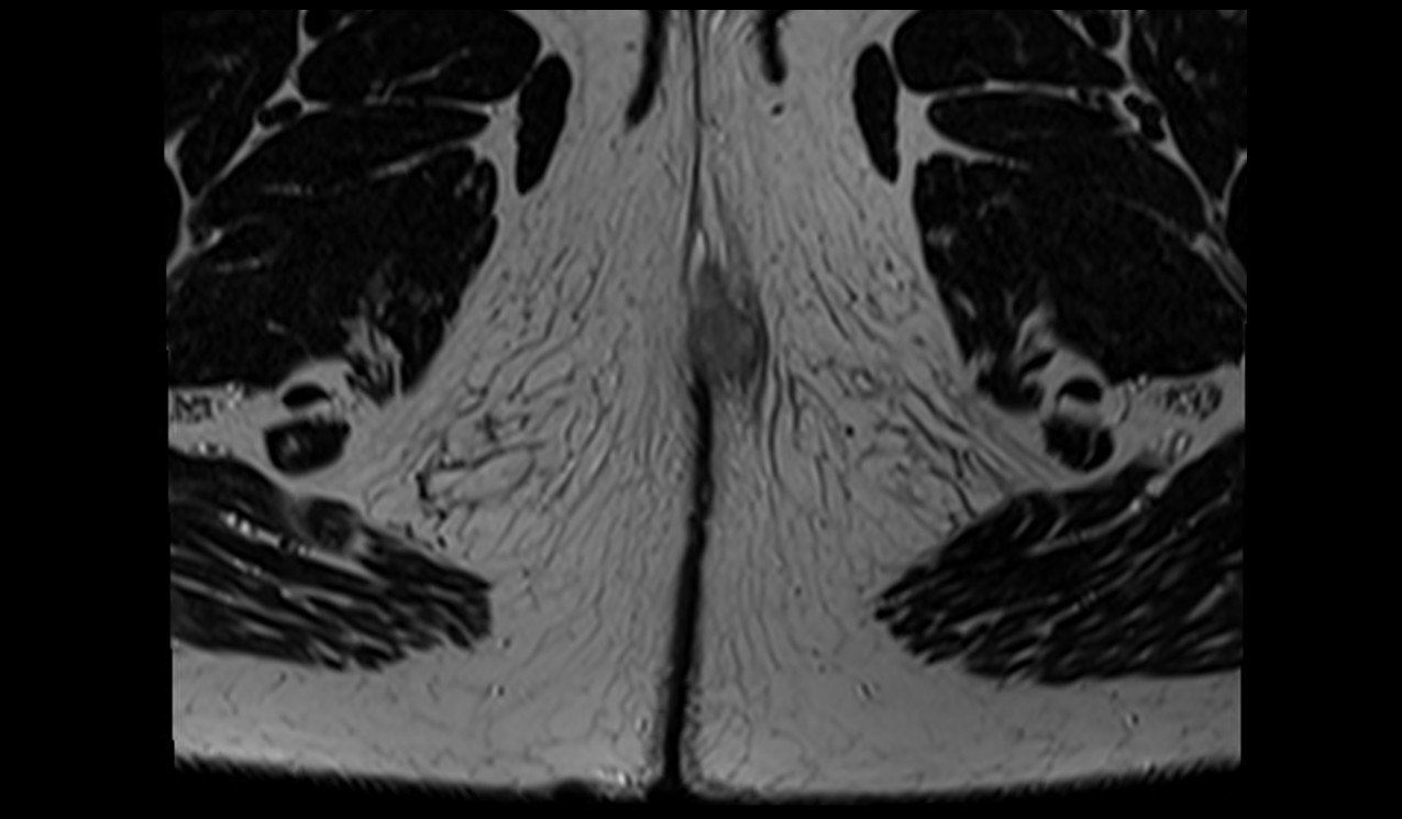 Perianal fistula MRI | Radiology article on Perianal fistula MRI