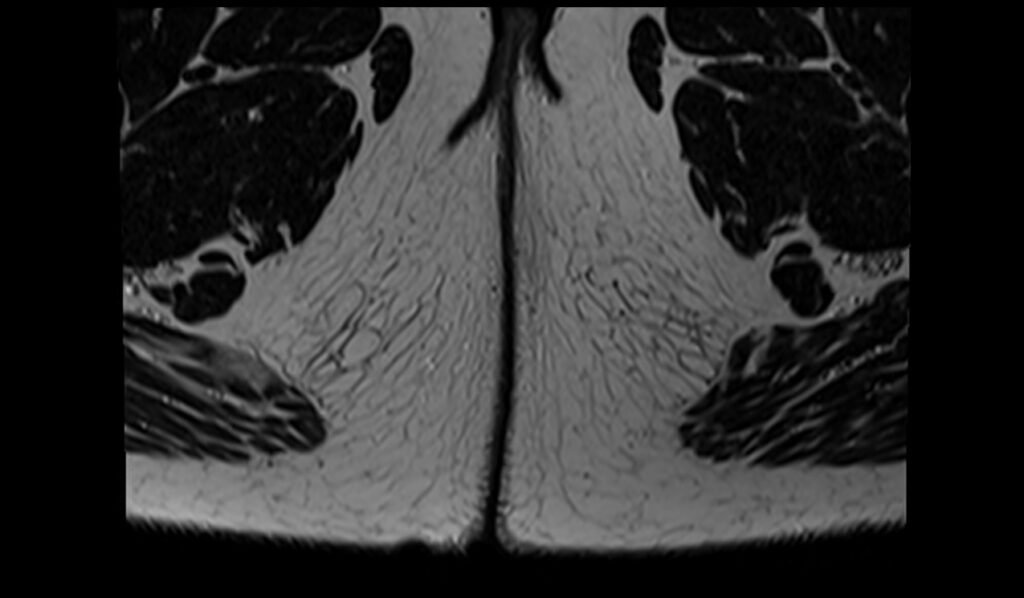 Perianal fistula MRI | Radiology article on Perianal fistula MRI
