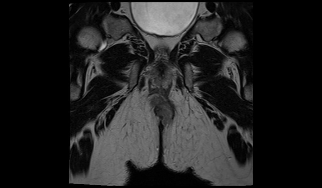 Perianal fistula MRI | Radiology article on Perianal fistula MRI