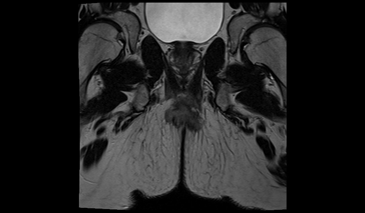 Perianal fistula MRI | Radiology article on Perianal fistula MRI