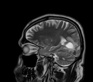 MRI Intracranial tuberculoma | Radiology Article Intracranial Tuberculoma