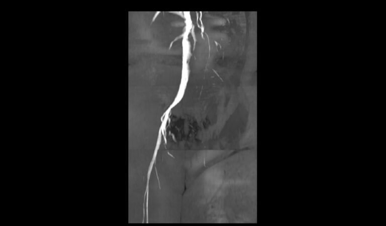 Iliofemoral deep vein thrombosis (DVT) MRI