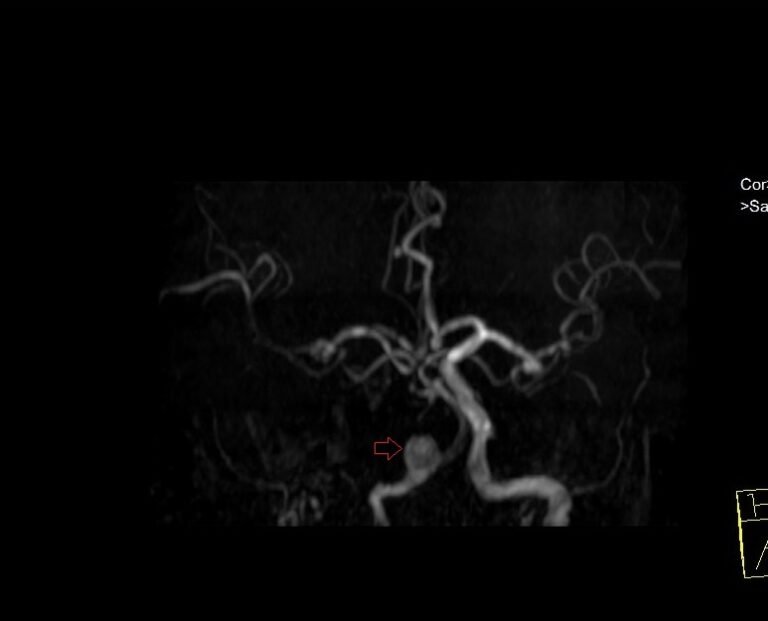 Cerebral aneurysm (berry aneurysms) MRI | Radiology Article on saccular ...