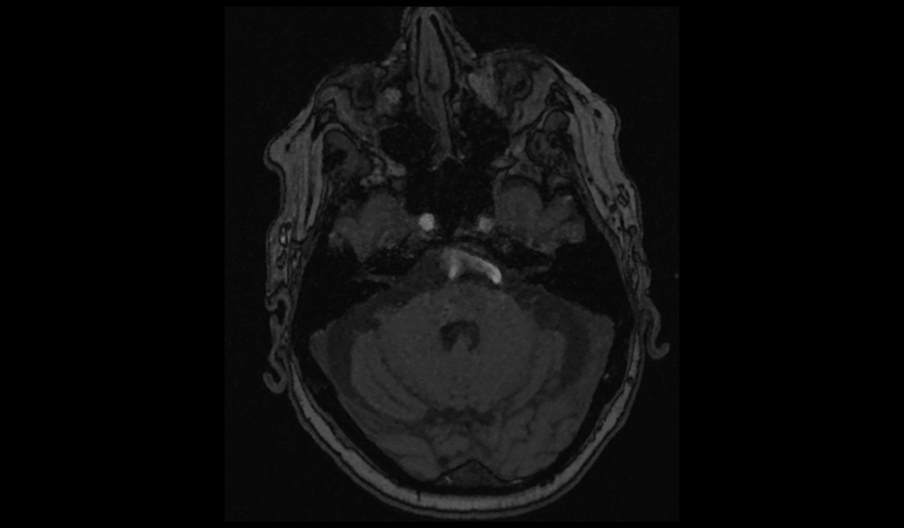 Cerebral aneurysm (berry aneurysms) MRI | Radiology Article on saccular ...