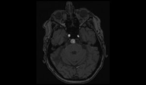 Cerebral aneurysm (berry aneurysms) MRI | Radiology Article on saccular ...