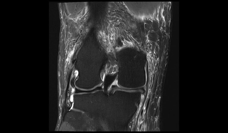 Baker's cyst rupture MRI | Radiology Article on Baker cyst rupture