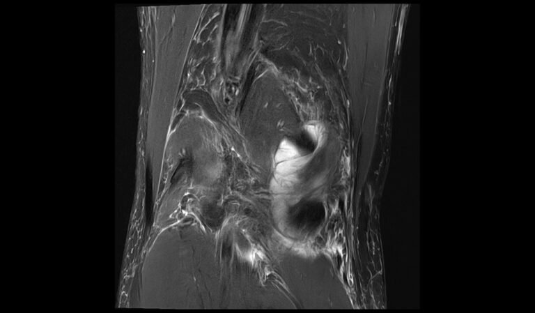 Baker's cyst rupture MRI | Radiology Article on Baker cyst rupture