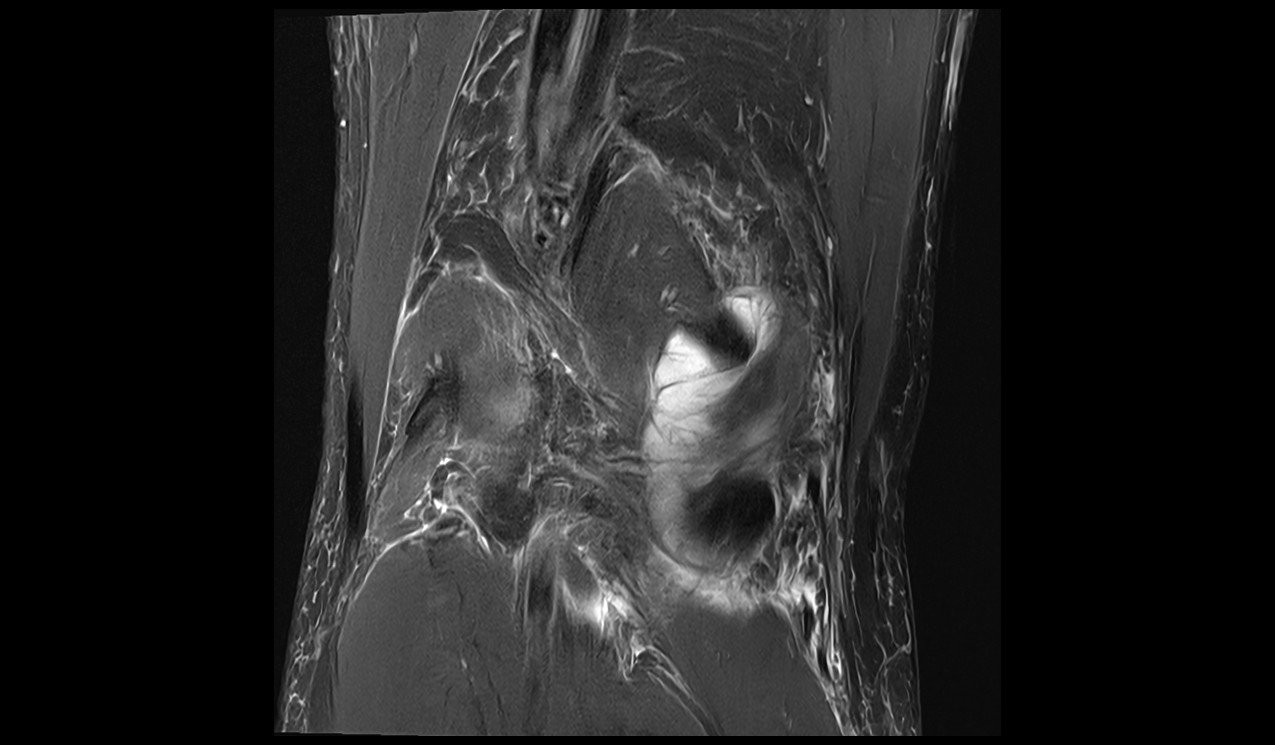 Baker's cyst rupture MRI | Radiology Article on Baker cyst rupture
