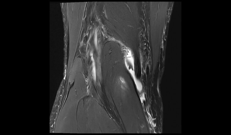 Baker's cyst rupture MRI | Radiology Article on Baker cyst rupture