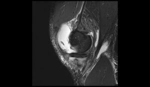 Baker's cyst rupture MRI | Radiology Article on Baker cyst rupture