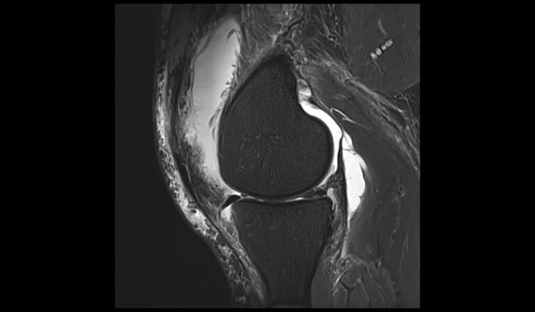 Baker's cyst rupture MRI | Radiology Article on Baker cyst rupture