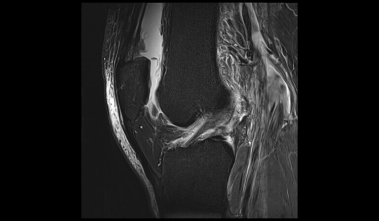 Baker's cyst rupture MRI | Radiology Article on Baker cyst rupture