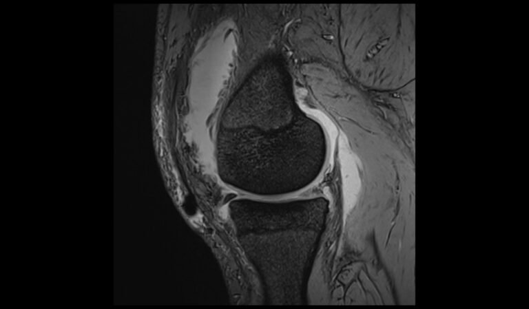 Baker's cyst rupture MRI | Radiology Article on Baker cyst rupture