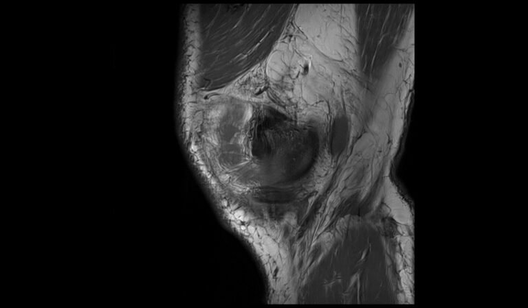 Baker's cyst rupture MRI | Radiology Article on Baker cyst rupture