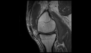 Baker's cyst rupture MRI | Radiology Article on Baker cyst rupture