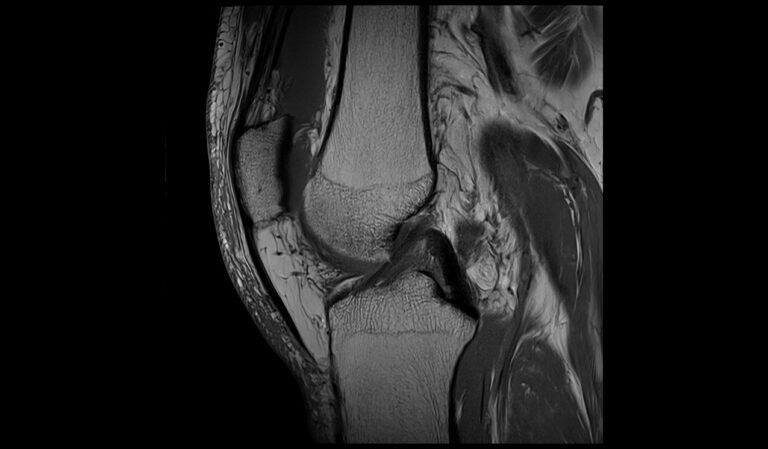 Baker's cyst rupture MRI | Radiology Article on Baker cyst rupture