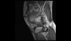Baker's cyst rupture MRI | Radiology Article on Baker cyst rupture