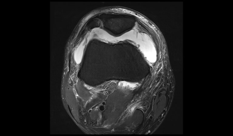 Baker's cyst rupture MRI | Radiology Article on Baker cyst rupture