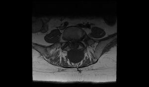 CSF leak MRI | Radiology article on CSF leak