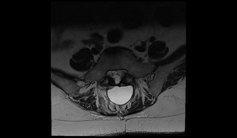 CSF leak MRI | Radiology article on CSF leak