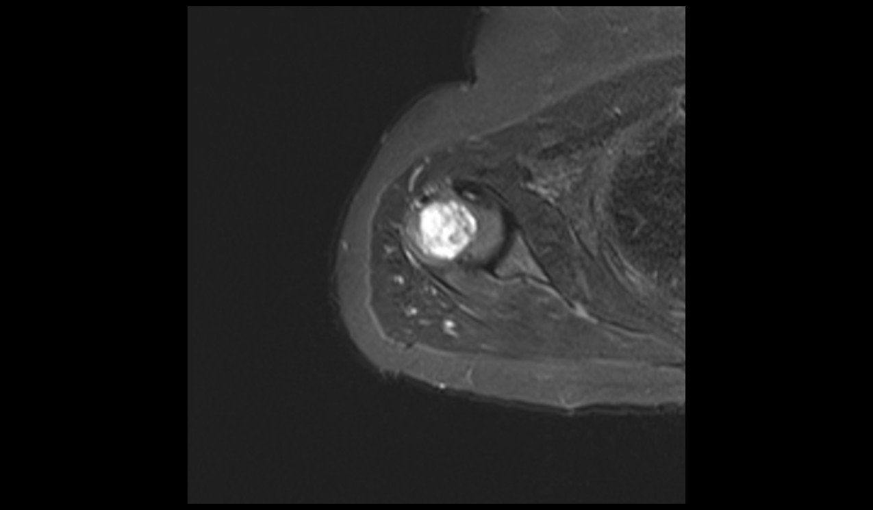 Enchondroma MRI | Radiology Article on Enchondroma MRI
