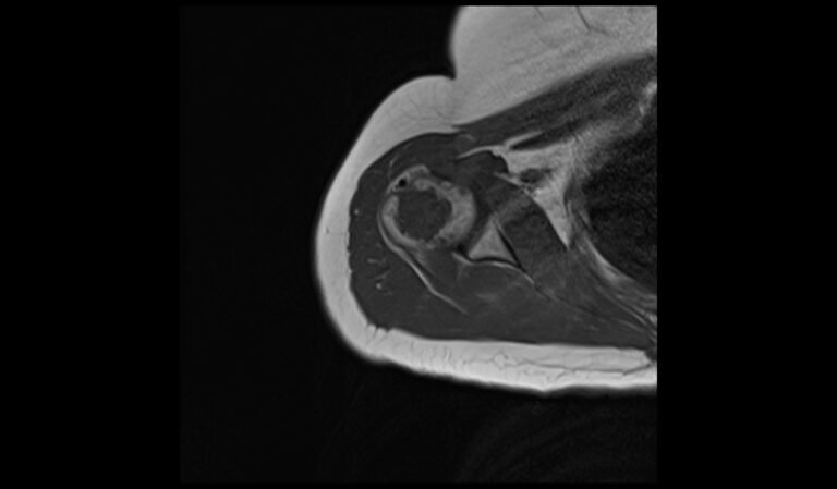 Enchondroma MRI | Radiology Article on Enchondroma MRI
