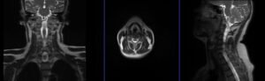 CSF Flow Chiari I Malformation MRI | Chiari I Malformation MRI protocol ...